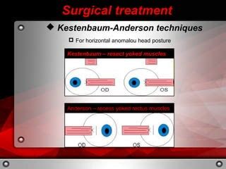 Nystagmus Ppt