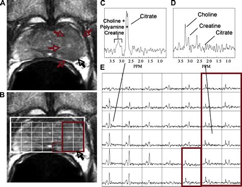 Advances In Mr Spectroscopy Of The Prostate Magnetic Resonance
