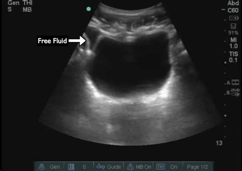 Tips And Tricks For The Pelvic Views During The Fast Exam —