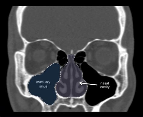 Maxillary Sinus