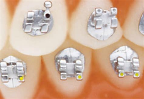 Metal Orthodontic Bracket Orthos® Ormco Twin