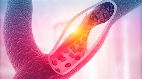 出血リスクの高い患者におけるdes留置後の短期dapt Vs 標準的なdapt Master Dapt試験15ヶ月追跡
