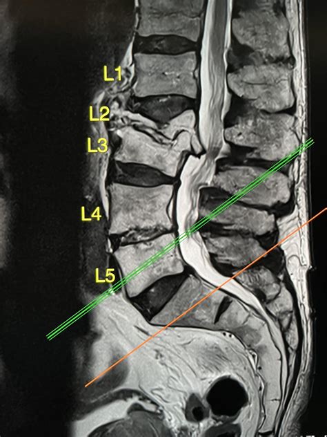 Spondylodiscitis Sequelae Rradiology