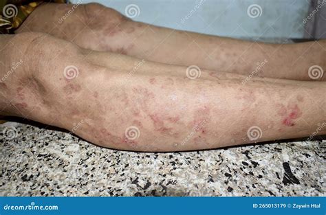 Fungal Infection Called Tinea Corporis In Leg Of Asian Woman Stock