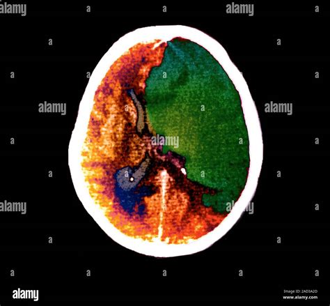 Brain In Stroke Coloured Computed Tomography Ct Scan Of An Axial Section Through The Brain Of
