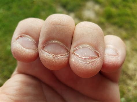 Hope For Nail Biters Can Bitten Nails Grow Back To Normal