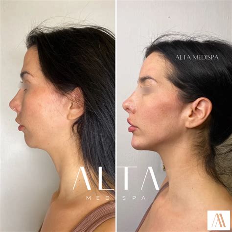 Jawline Filler Before And After Alta Medi Results
