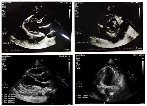 Echocardiography A Before Pericardiocentesis B After