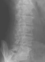 Spondylolysis