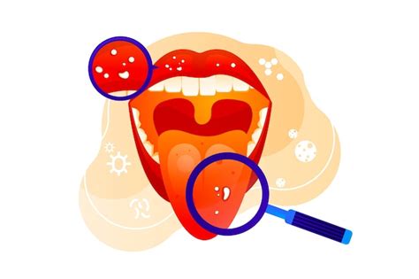 Gradient Stomatitis Illustration Free Vector