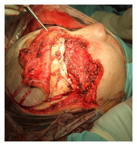 Primary Orbital Mesenchymal Chondrosarcoma Case Report And Review Of