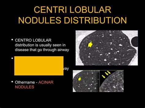 Patterns In Hrct Chest Pptx Lung And Respiratory Health Diseases And Conditions
