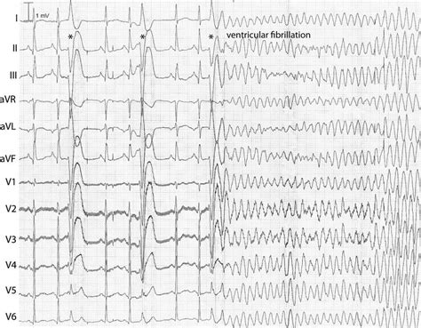 Ventricular Fibrillation Heart And Blood Vessel Disorders Msd