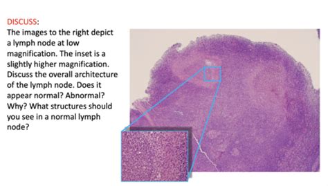 Week 4 Benign Lymph Node Pathology Flashcards Quizlet