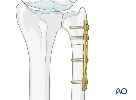 Ulna
