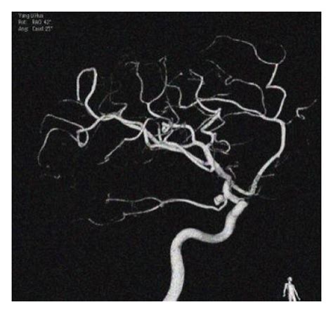 Aneurysm 3d Visual Image Results A Original Image B Cnn Model