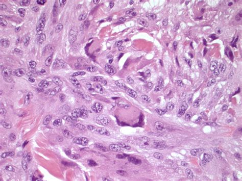 Pathology Outlines Undifferentiated Unclassified Sarcoma