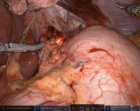 Robotic Heller Myotomy And Fundoplication Techniques And Outcomes