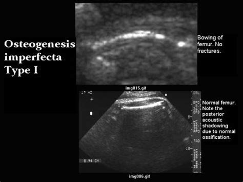 Osteogenesis Imperfecta Ultrasound Nikki And Sean Oi Brittle Bones