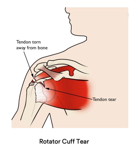 Rotator Cuff Tears Dr Pant Sydney Shoulder Unit