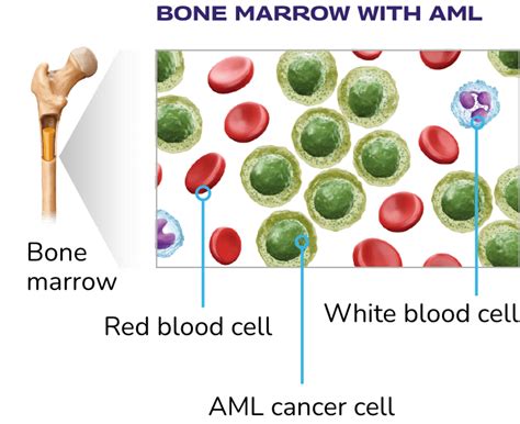 What Is Aml Vanflyta® Quizartinib