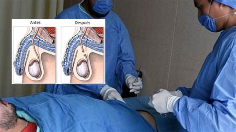 Mitos Y Verdades Sobre La Vasectomía Un Efectivo Mand Xe