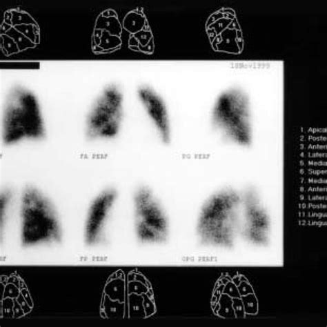 A Perfusion Isotope Lung Scan Ventilation And Perfusion Isotope Lung