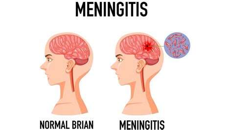 What Microorganism Causes Meningitis