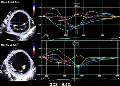Additive Prognostic Value Of Echocardiographic Global Longitudinal And