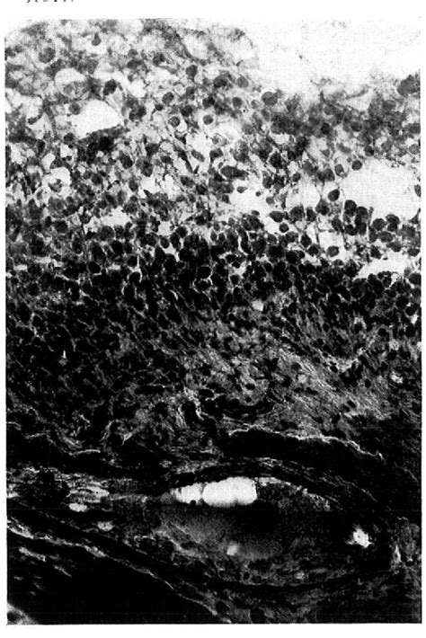Figure 2 From Cyclophosphamide Hemorrhagic Cystitis Authors Transl Semantic Scholar