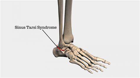Sinus Tarsi Syndrome How To Treat Sinus Tarsi Syndrome