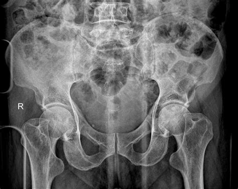 Biomet Hip Lawsuit Filed Over Defective M2a Metal On Metal Implant