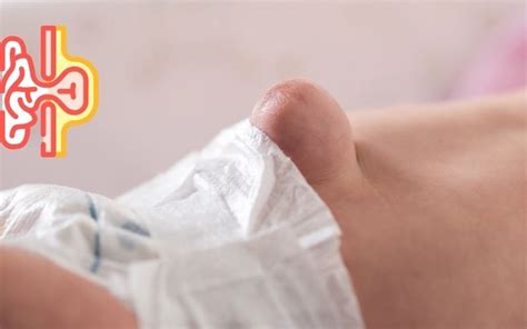 Different Types Of Hernia Disease In Male And Female Primus Super