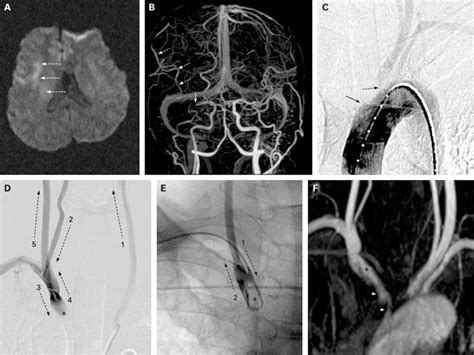 A An Initial Diffusion Weighted Image Shows Areas Of Subtle Diffusion