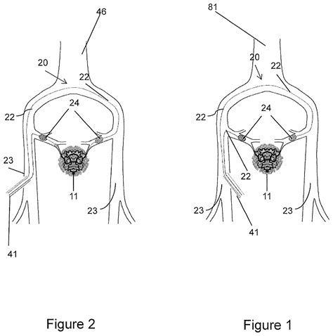 Devices And Methods For Vascular Hyperperfusion Of Extravascular Space
