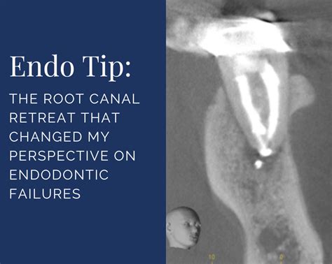 Failed Dental X Rays What To Do When Radiographs Arent Enough Clinical