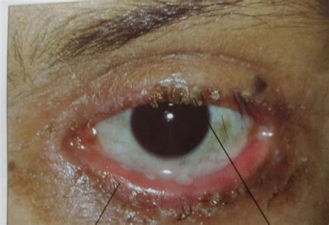 Understanding The Blepharitis Causes Symptoms And Treatment