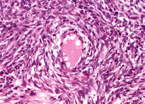 Uterine Sarcoma At 20x Magnification Microscopyu