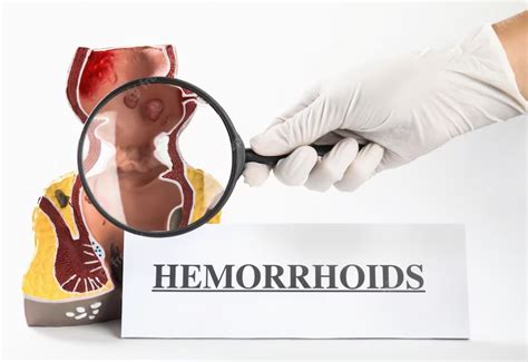 Understanding Pileshemorrhoids Causes Symptoms Diagnosis And
