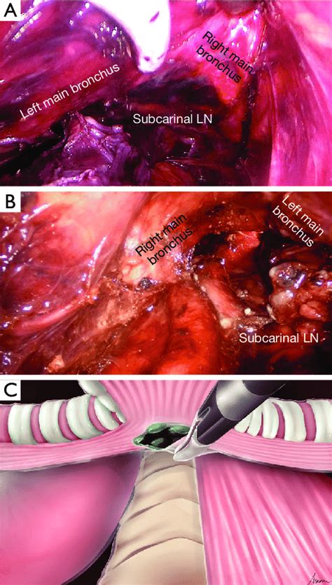 Subcarinal Lymphadenectomy A Dissection Of Subcarinal Lymph Nodes