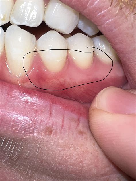 Does This Look Like Gingivitis Raskdentists