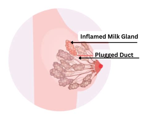 Breastfeeding Challenges Common Challenges