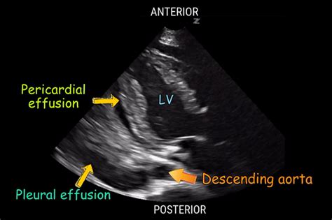 Cardiac Tamponade Scvmc Im Chief Resident Blog