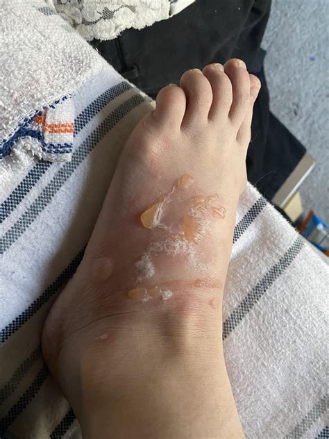 Burned My Foot With Boiling Water Progress Pics Rpopping