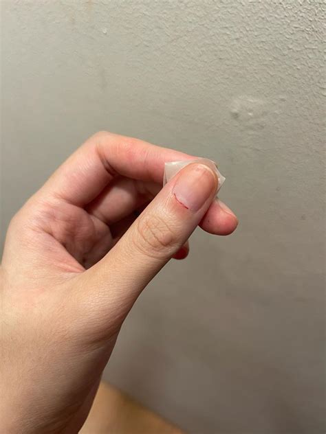 Womans Cuticle Started Bleeding But Finger Spa Manicurist Says “oh Your Skin Is Too Thin That