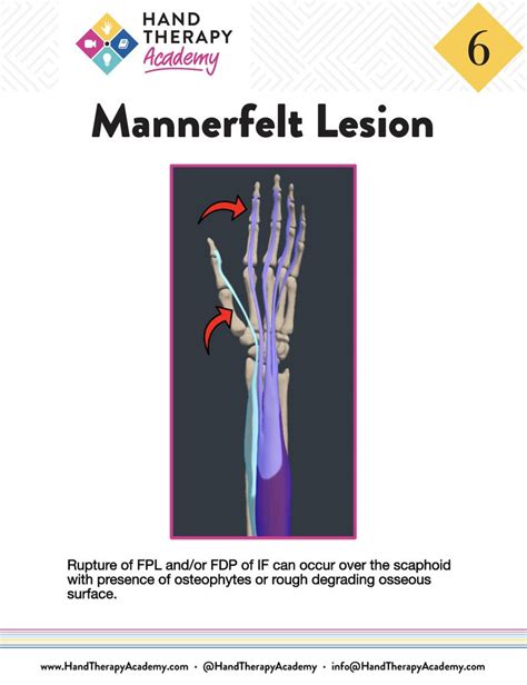 Tendon Transfer Training E Book Hand Therapy Academy