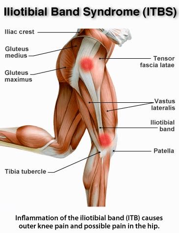 Preventing And Managing Iliotibial Band Syndrome Itbs Stockport