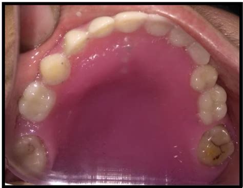 Figure 7 From Cu Sil Denture An Innovative Approach To Preserve The