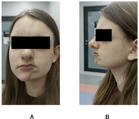 Tofacitinib Treatment In A Girl With Localized Scleroderma Of The Head