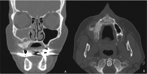 Maxillary Sinus Infection Complications Complications Of Maxillary